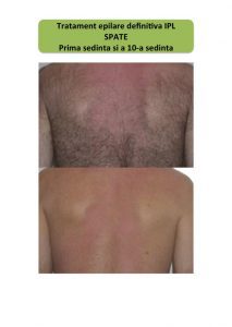 Epilare Definitiva Laser si IPL | Pret Avantajos | Nomasvello